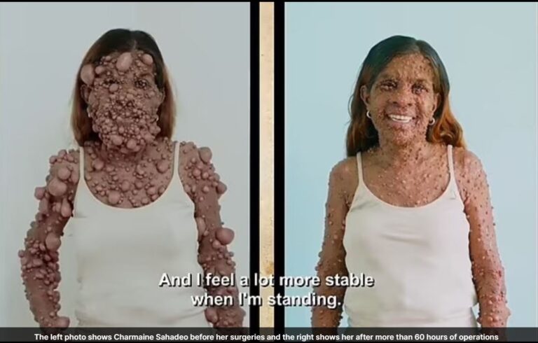 Opmerkelijk: Meer dan 60 uur chirurgie om duizenden tumoren te ...