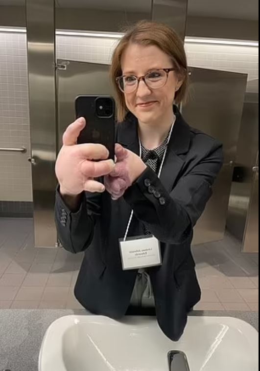 Uitdagingen van een Zeldzame Ziekte: Het Verhaal van Lindsey Johnson Edwards – Dagblad Suriname